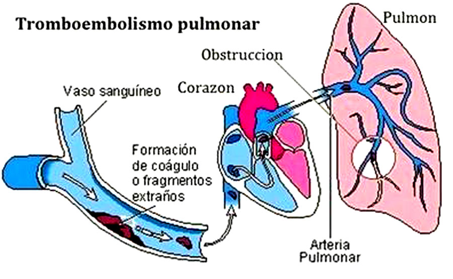 Enfermedad tromboembólica venosa: Un enemigo pequeño, pero de cuidado ...